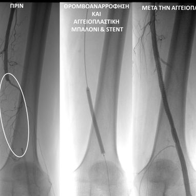 Παθήσεις φλεβικές αγγειακές αρτηριακές | Dr. ΔΗΜΗΡΟΠΟΥΛΟΣ ΦΙΛΙΠΠΟΣ